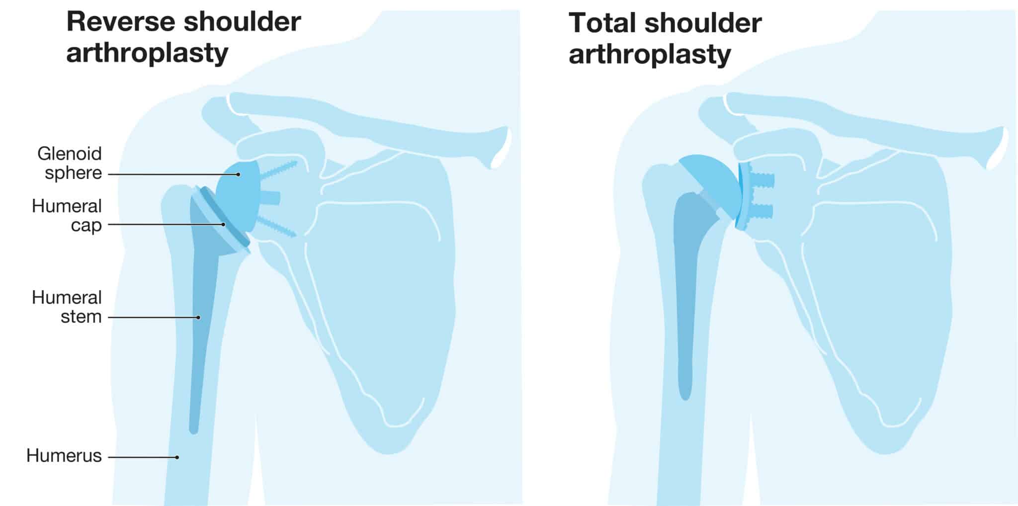 Navigating Shoulder Replacement Surgery Recovery Time - Physio Ed.