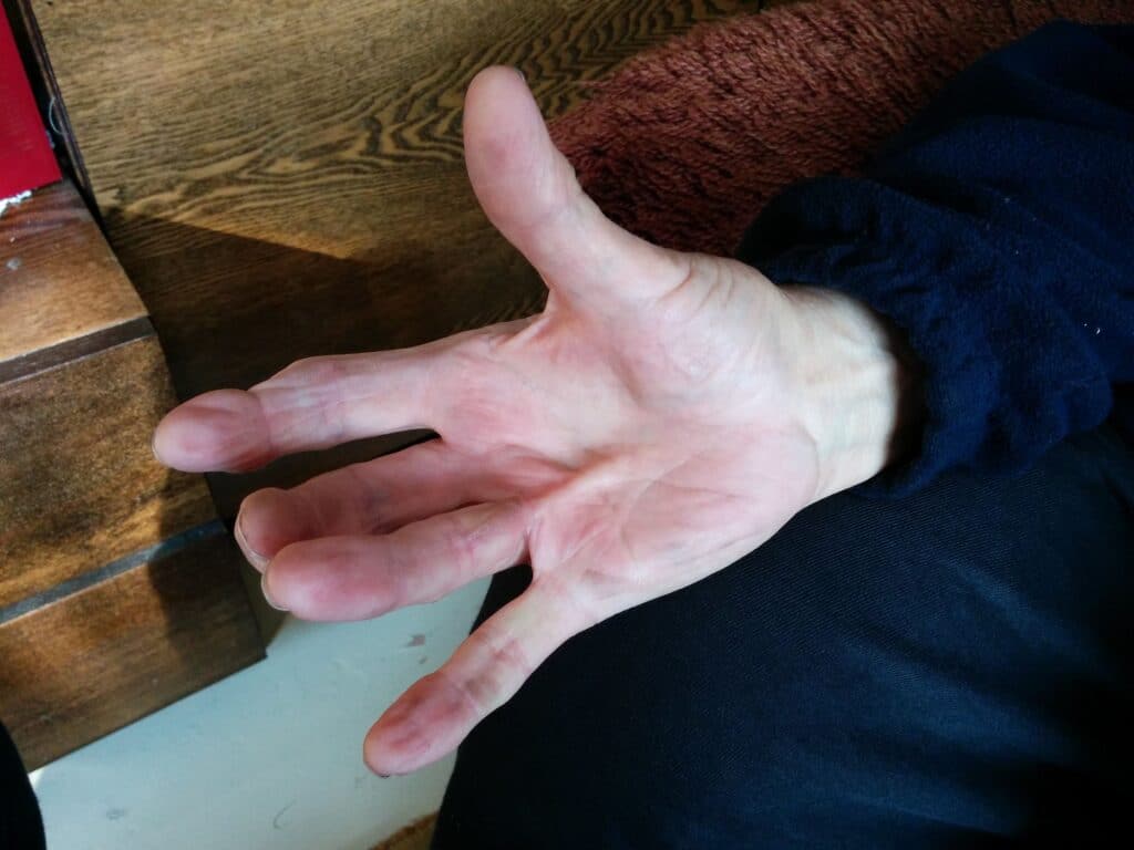 Understanding Dupuytren's Contracture - Physio Ed.